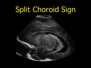Neonatal Cranial & Spinal Ultrasound | PDF