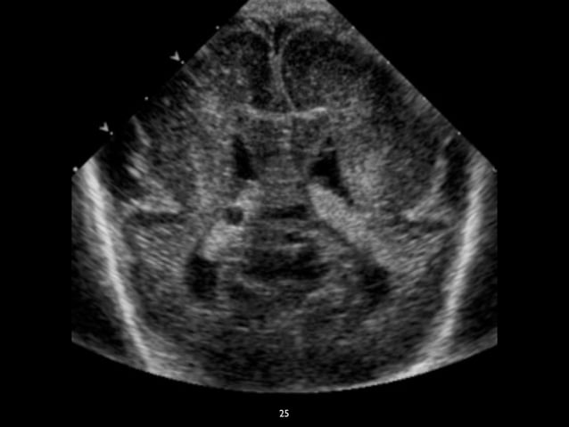 Neonatal Cranial & Spinal Ultrasound | PDF | Brain and Nervous System ...