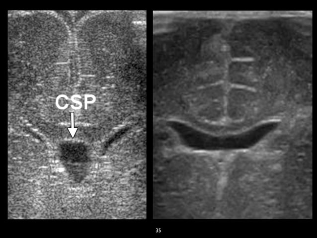 Neonatal Cranial & Spinal Ultrasound | PDF | Brain and Nervous System ...