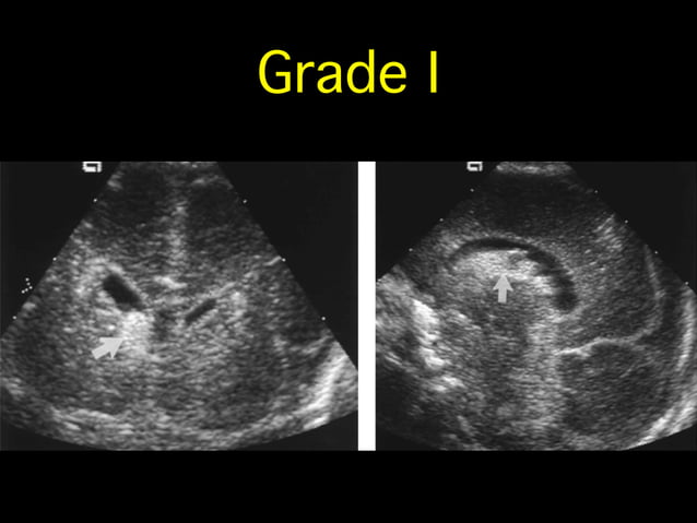 Neonatal Cranial & Spinal Ultrasound | PDF | Brain and Nervous System ...