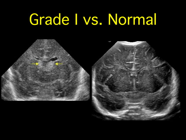 Neonatal Cranial & Spinal Ultrasound | PDF | Brain and Nervous System ...