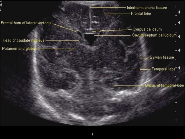 Neonatal Cranial & Spinal Ultrasound | PDF | Brain and Nervous System ...