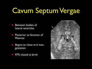 Cavum Vergae Ultrasound
