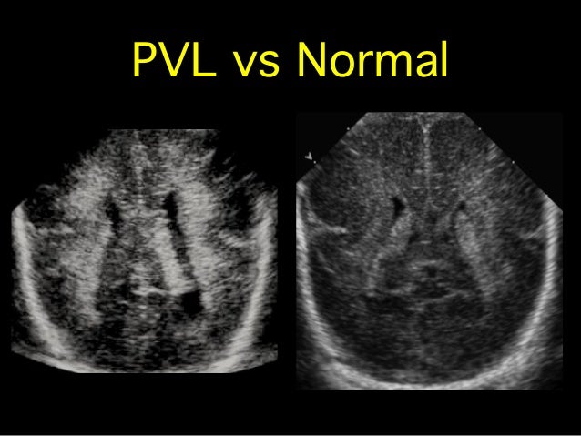 Neonatal Cranial & Spinal Ultrasound
