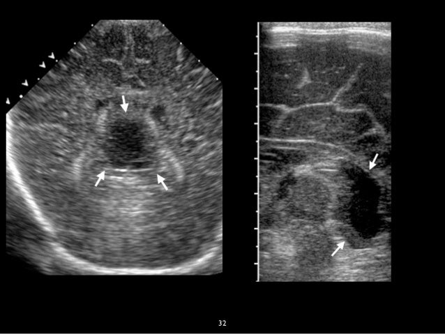 Neonatal Cranial & Spinal Ultrasound