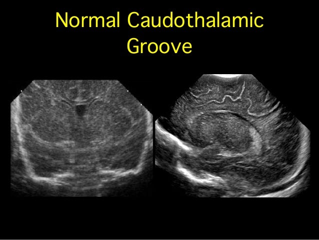 Neonatal Cranial & Spinal Ultrasound