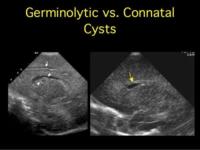 Neonatal Cranial & Spinal Ultrasound