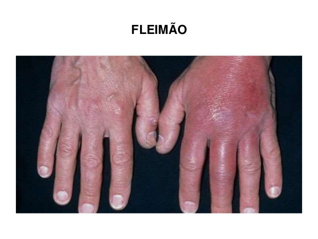 Aula infecções de pele