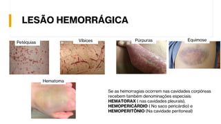 aula 06 - Distúrbios Hemodinâmicos ( circulatórios).pdf