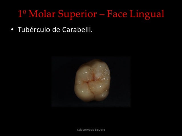 Aula 08 molares superiores