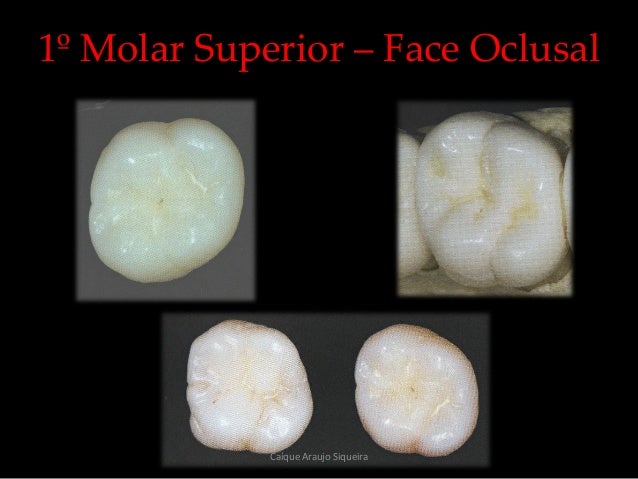 Aula 08 molares superiores