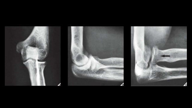 Aula 1 - Avaliação radiológica do cotovelo | PPT