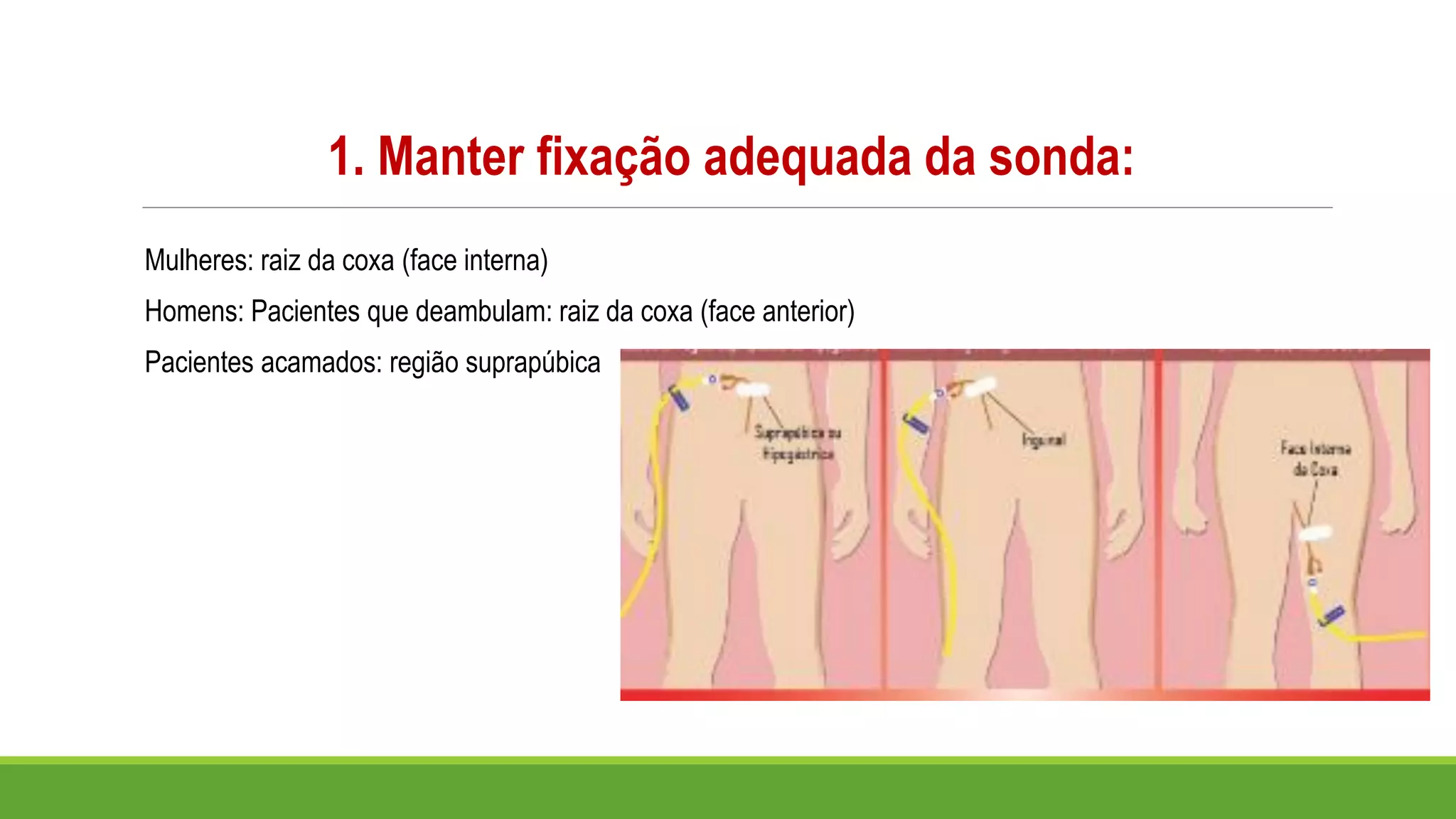 Aula 14 - Sondagem vesical.pdf