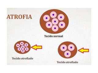 Atrofia Celular