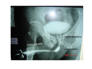 Radiologianota10 uretrocistografia retrógrada e miccional | PPT ...
