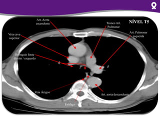 Aula 4 Anatomia seccional TC da caixa toracica.pdf