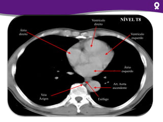 Aula 4 Anatomia seccional TC da caixa toracica.pdf