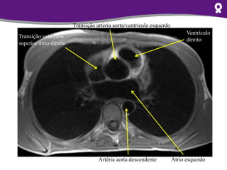 Aula 4 Anatomia seccional TC da caixa toracica.pdf
