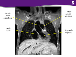 Aula 4 Anatomia seccional TC da caixa toracica.pdf
