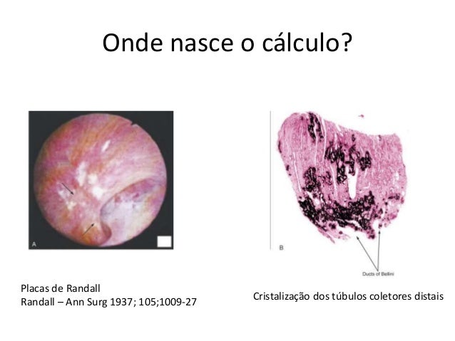 Aula Litíase renal - Dr Alex Meller