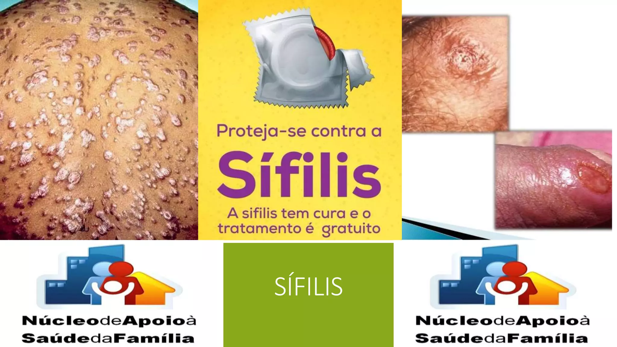 Aula 5 - Sifílis (1).pptx