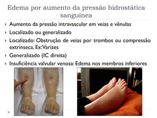 aula de edema e circulacao patologia geral | PDF