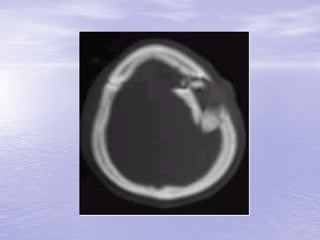 Aula Trauma cranio encefalico para enfermagem | PPT