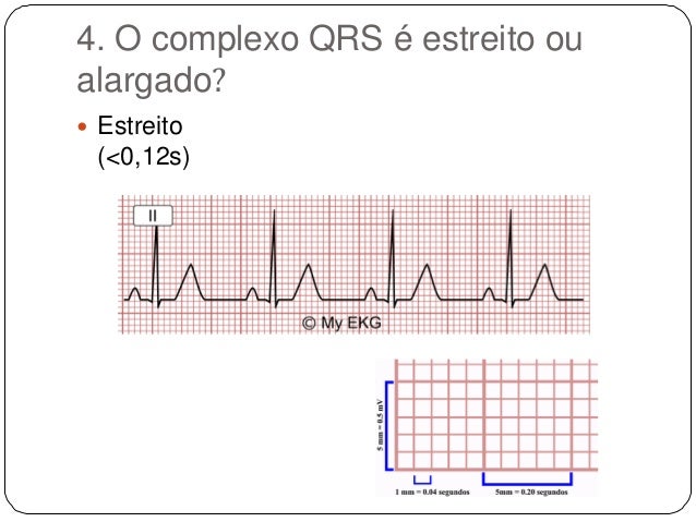 Aula arritmias e interpretação de ECG