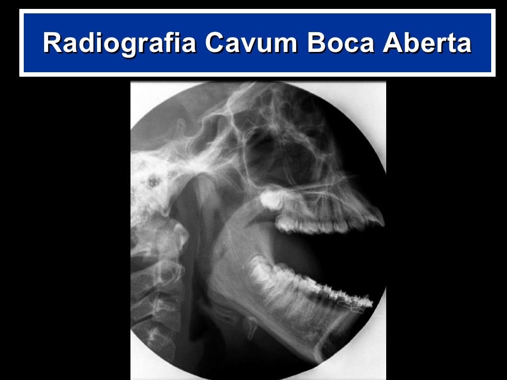 Aula Científica Sobre Seios Paranasais e Cavum