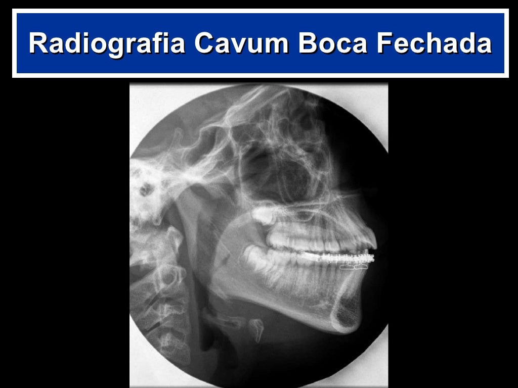 Aula Científica Sobre Seios Paranasais e Cavum