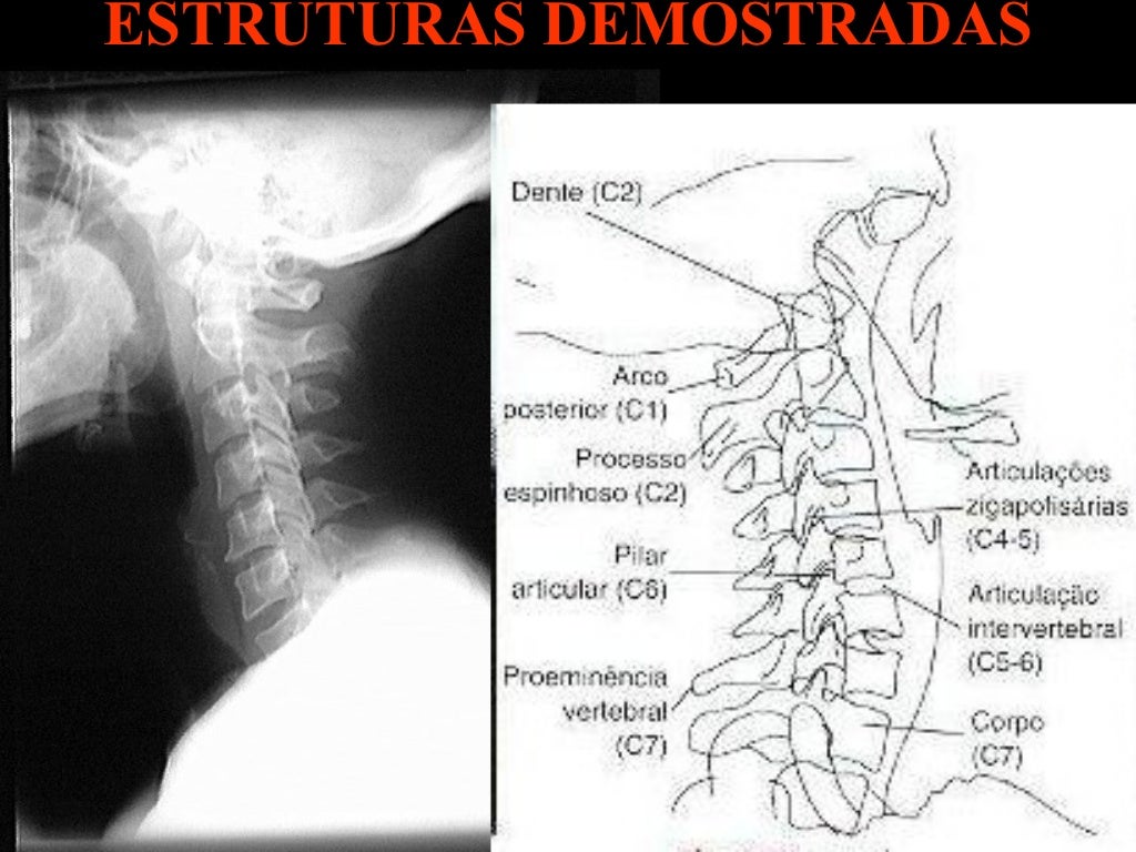 Radiografia Da Coluna Cervical Saudavel