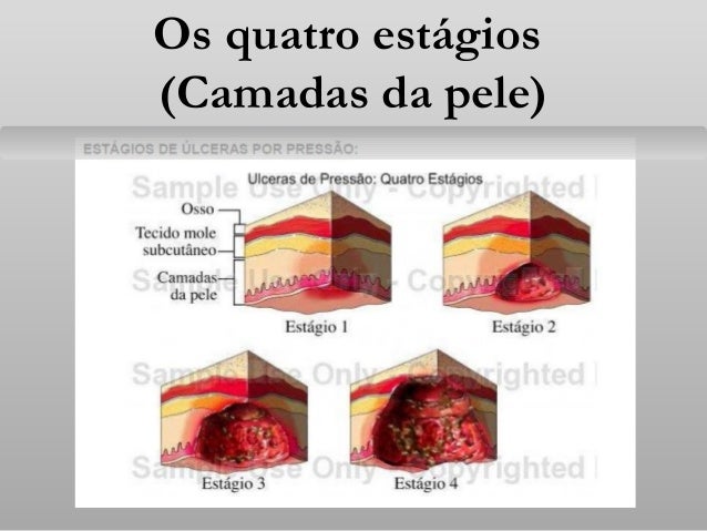 Aula de feridas e curativos - Completa