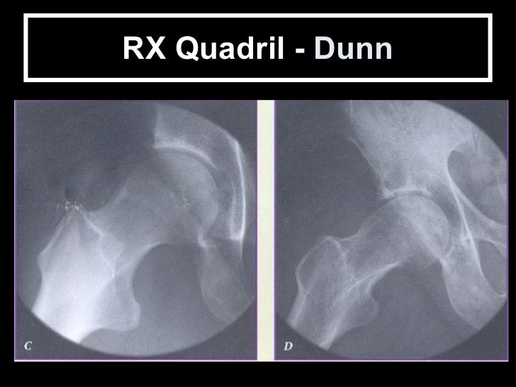 Aula sobre quadril, série para sindrome do impacto femoro acetabular