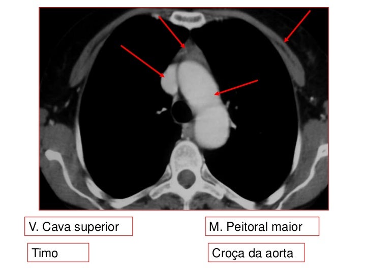 TC de tórax janela de mediastino