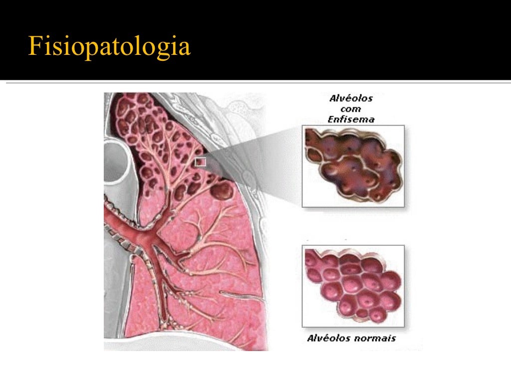 DPOC - Doenca Pulmonar Obstrutiva Cronica