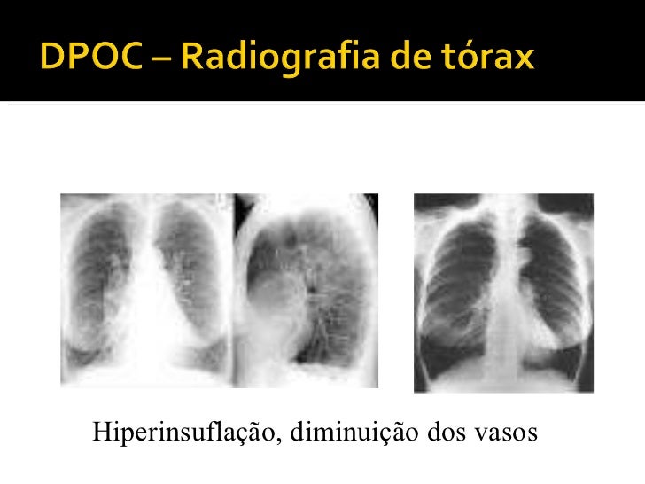 DPOC - Doenca Pulmonar Obstrutiva Cronica