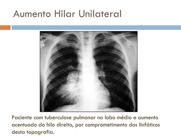 Radiologia torácica: Hilos pulmonares e Doenças do Mediastino