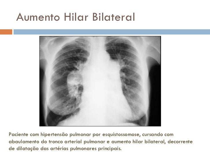Radiologia torácica: Hilos pulmonares e Doenças do Mediastino