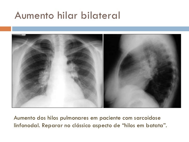 Radiologia torácica: Hilos pulmonares e Doenças do Mediastino