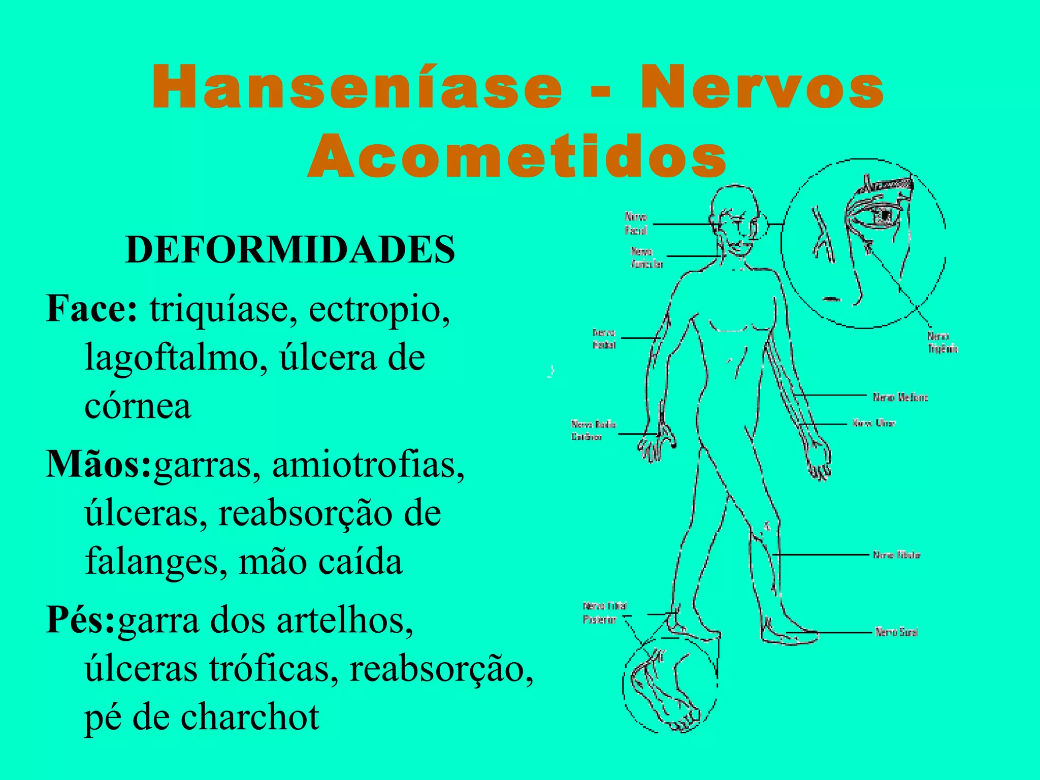 Aula Hanseníase | PPT