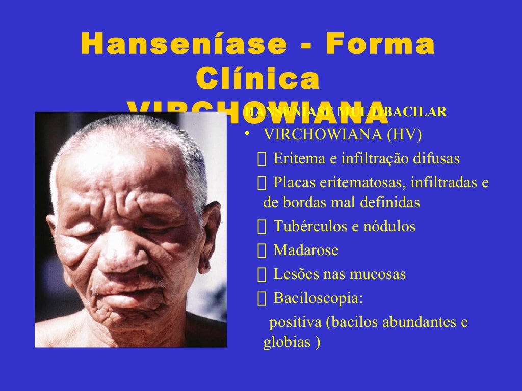 Fenomeno De Lucio Hanseniase - BRAINCP