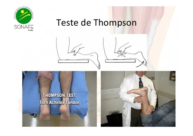 Ruptura do Tendão de Aquiles