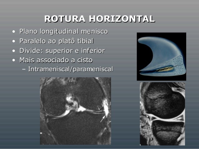 Meniscos - Aspectos radiológicos das rupturas e outras lesões