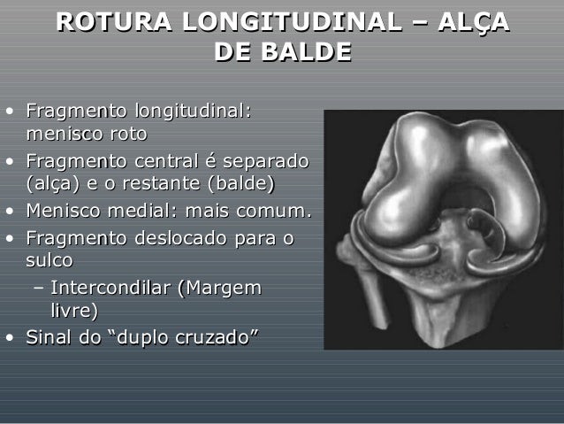 Meniscos - Aspectos radiológicos das rupturas e outras lesões