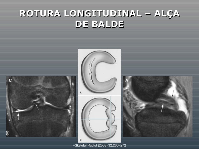 Meniscos - Aspectos radiológicos das rupturas e outras lesões