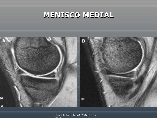Meniscos - Aspectos radiológicos das rupturas e outras lesões