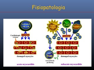 Aula miocardite tatiana caus | PPT