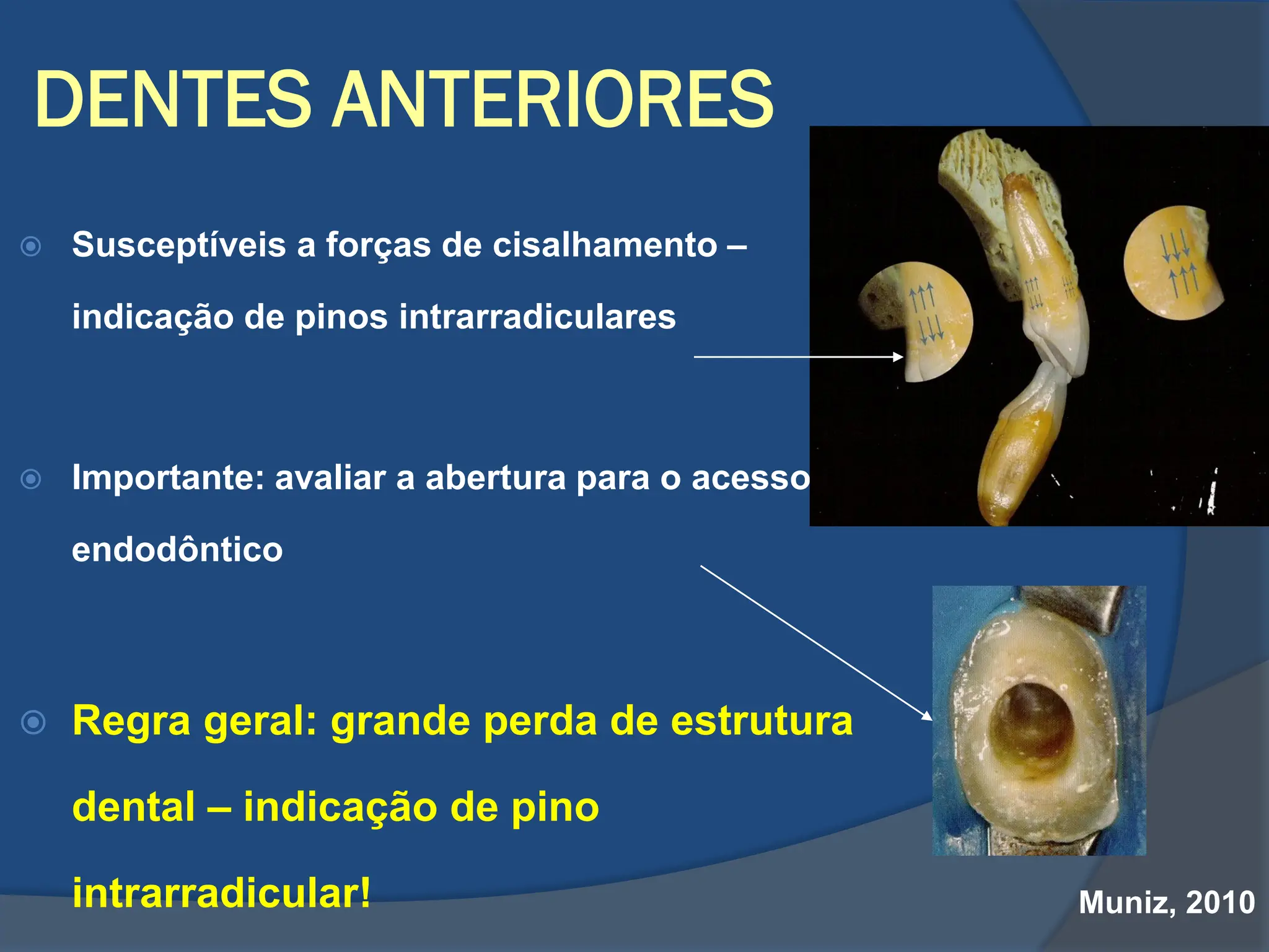 Aula Nucleo metalico fundido para dentes tratados endodonticamente | PDF