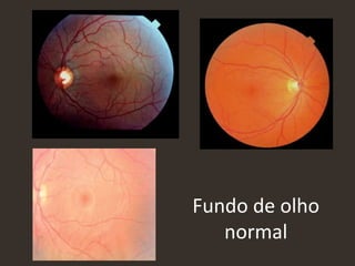 Oftalmoscopia | PPTX