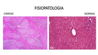 Aula Patologia - cirrose hepática.pptx